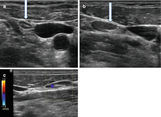 Ultrasound of the Thyroid and Soft Tissues of the Neck | SpringerLink
