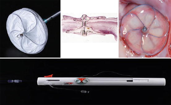 PFO Closure: Techniques and Devices | SpringerLink