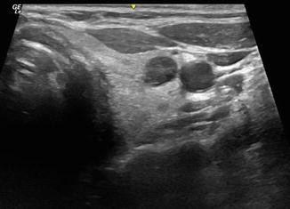 Feature Illustration: Thyroid Nodule Margins and Extrathyroidal ...