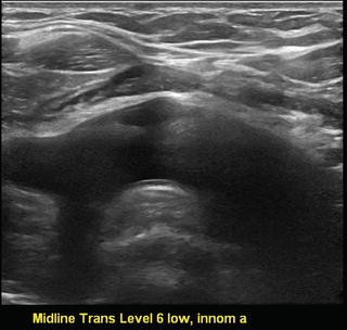 Normal Cervical Lymph Node Appearance and Anatomic Landmarks in Neck ...