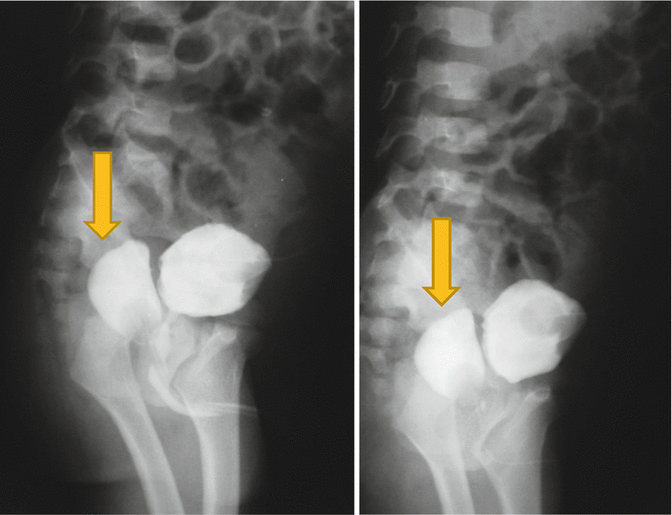 Utricular Cyst (Prostatic Utricular Cyst) | SpringerLink