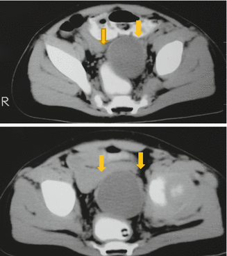 Utricular Cyst (Prostatic Utricular Cyst) | SpringerLink