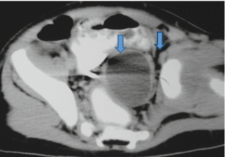 Utricular Cyst (Prostatic Utricular Cyst) | SpringerLink