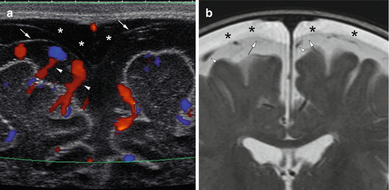 Skull, Subdurals, and Brain | SpringerLink