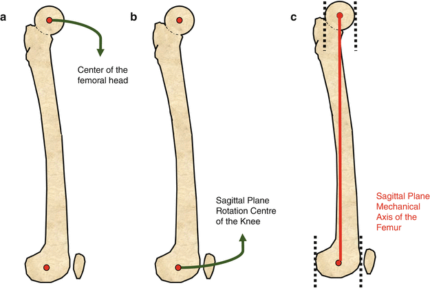 Sagittal Plane Deformities and Malorientation Test | SpringerLink