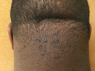 Pseudofolliculitis Barbae and Acne Keloidalis Nuchae | SpringerLink