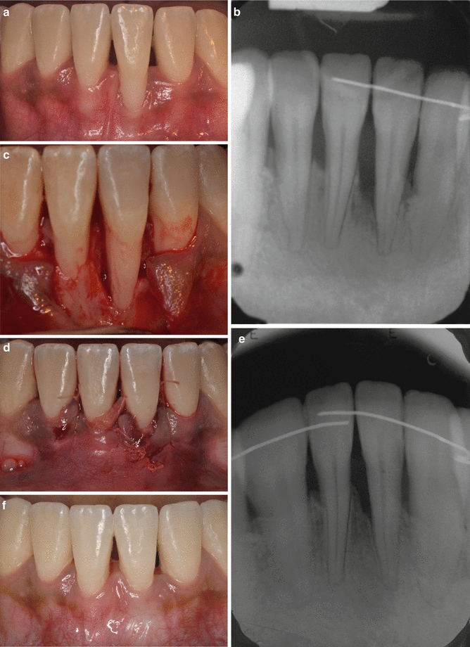 Evidence-Based Decision Making in Periodontal Tooth Prognosis and ...