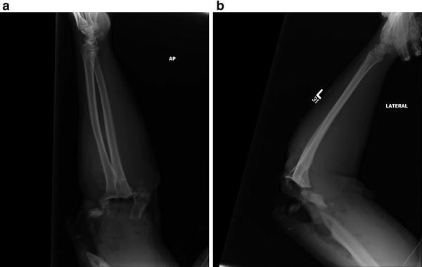 Elbow Fusion for The Unstable Elbow | SpringerLink