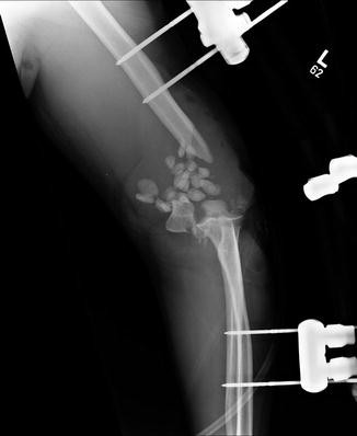 Elbow Fusion for The Unstable Elbow | SpringerLink