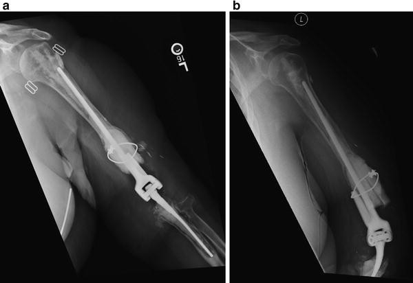 Elbow Fusion for The Unstable Elbow | SpringerLink