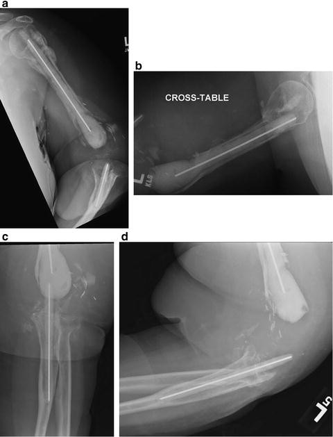 Elbow Fusion for The Unstable Elbow | SpringerLink