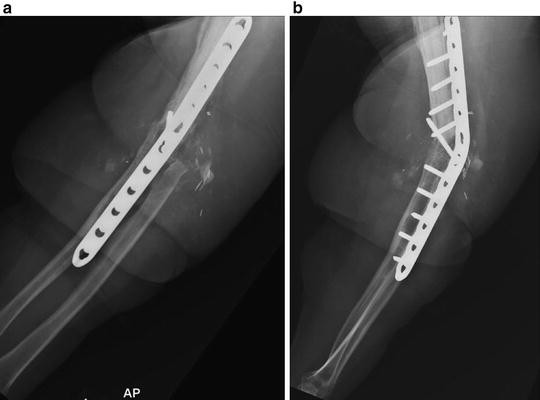 Elbow Fusion for The Unstable Elbow | SpringerLink