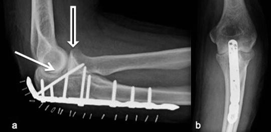 Transolecranon Fracture-Dislocations | SpringerLink