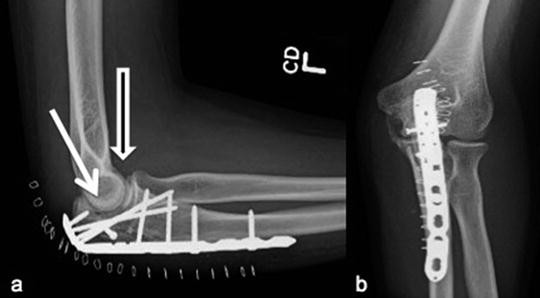 Transolecranon Fracture-Dislocations | SpringerLink