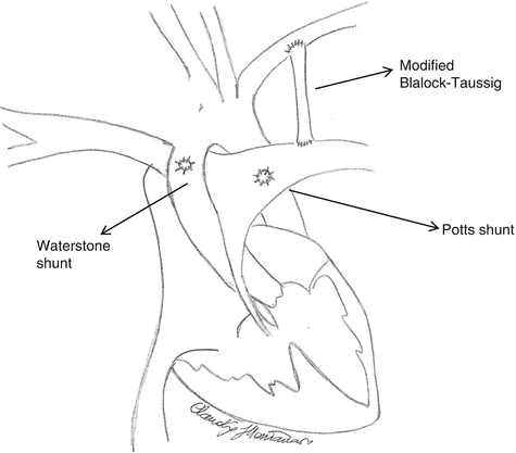 Segmental Pulmonary Hypertension | SpringerLink