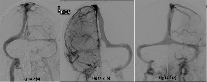 Monitoring of Jugular Venous Oxygen Saturation | SpringerLink