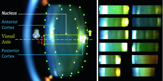 Semantic Reconstruction-Based Nuclear Cataract Grading from Slit-Lamp ...