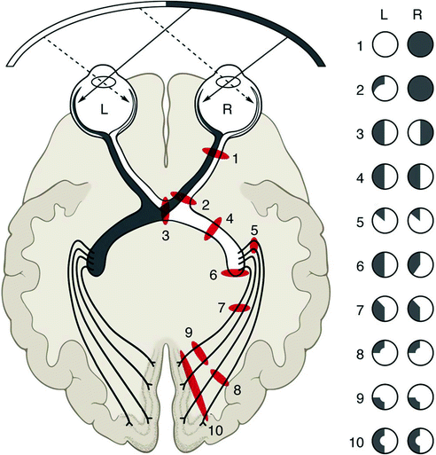 Optic Nerve, Visual Pathways, Oculomotor System, and Consequences of ...