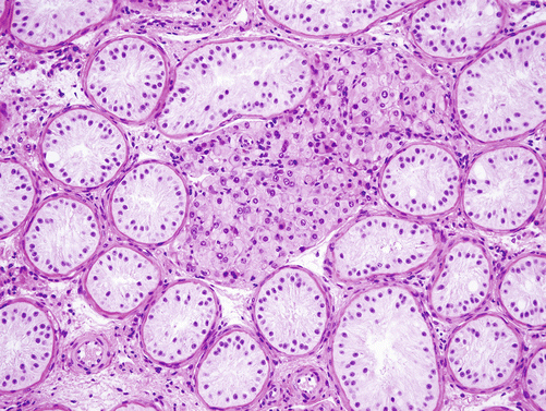 Testicular Dysgenesis Syndrome Tds Springerlink
