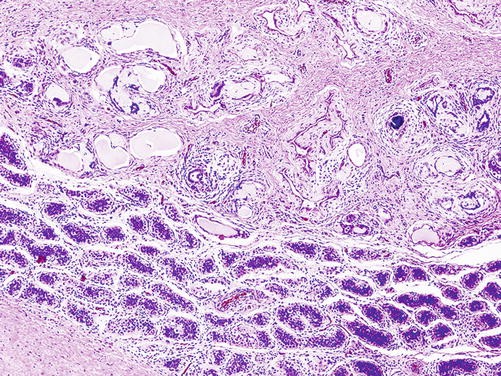 Congenital Cystic Pathology of the Rete Testis | SpringerLink