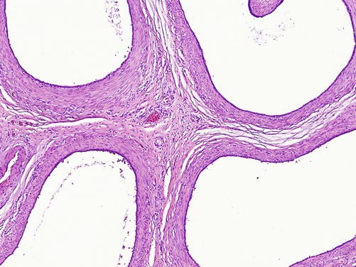 Congenital Cystic Pathology of the Rete Testis | SpringerLink