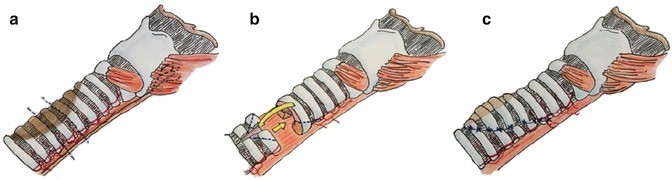 Slide Tracheoplasty | SpringerLink