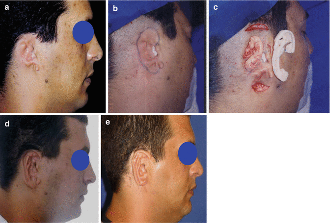 Traumatic Amputation of the Ear: What to Do with the Amputated Segment ...