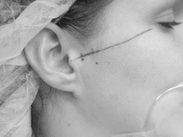 Facial Nerve Injury | SpringerLink