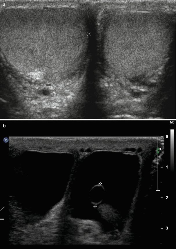 Scrotal and Testicular Anatomy | SpringerLink