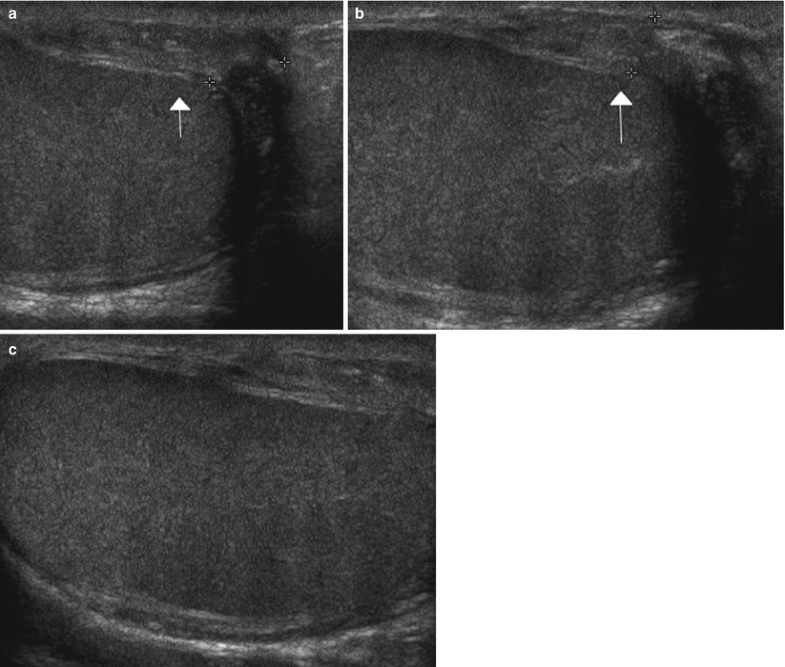Extratesticular Lesions | SpringerLink