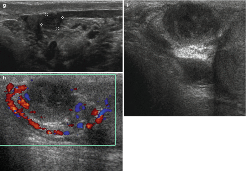 Extratesticular Lesions | SpringerLink