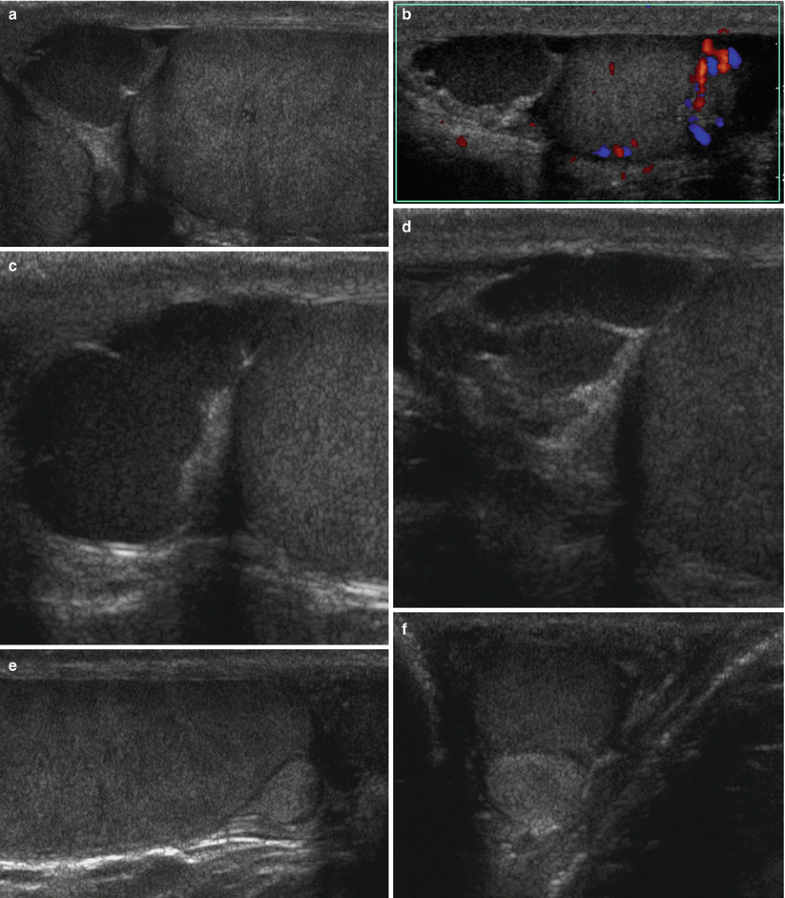Extratesticular Lesions | SpringerLink