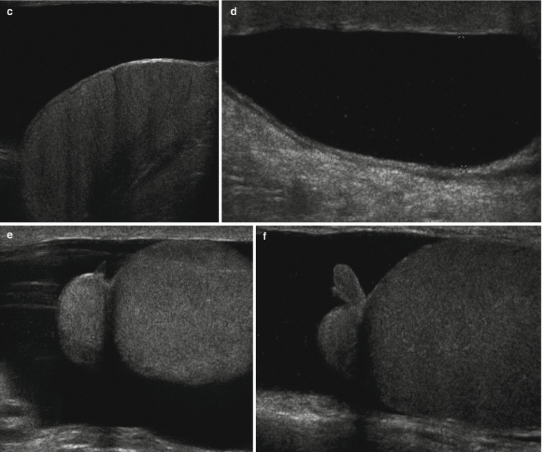 Extratesticular Lesions | SpringerLink