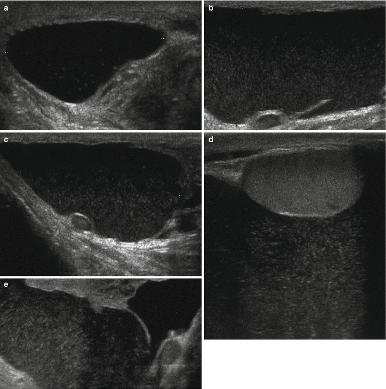 Extratesticular Lesions | SpringerLink