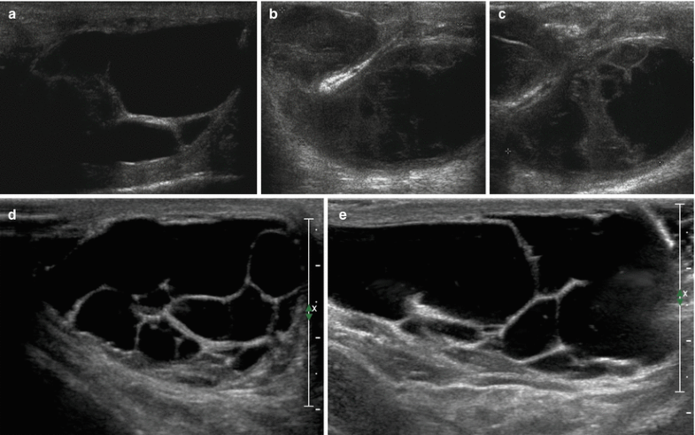 Extratesticular Lesions | SpringerLink