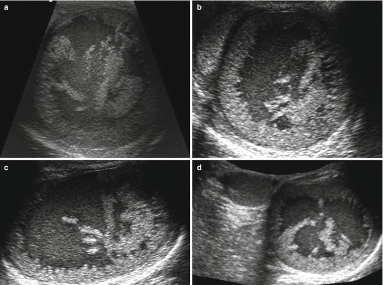 Extratesticular Lesions | SpringerLink