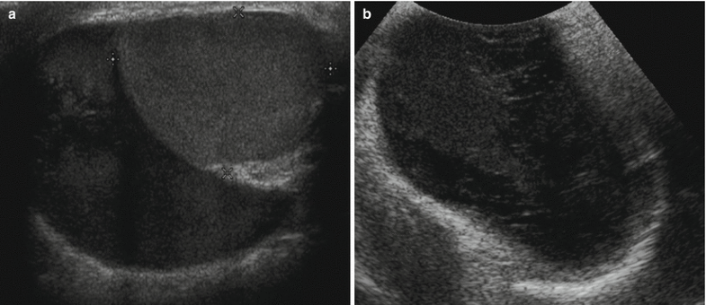 Extratesticular Lesions | SpringerLink