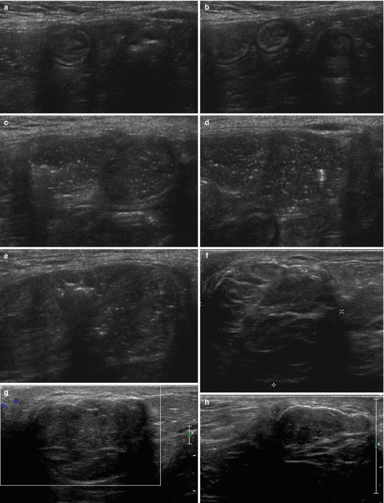 Extratesticular Lesions | SpringerLink