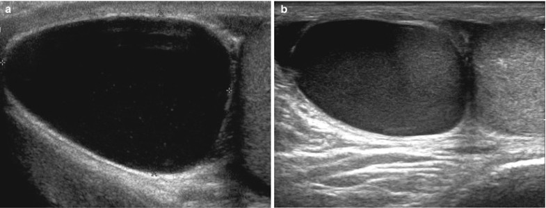 Extratesticular Lesions | SpringerLink