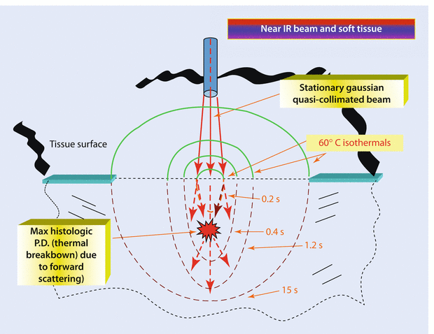 Laser–Tissue Interaction | SpringerLink