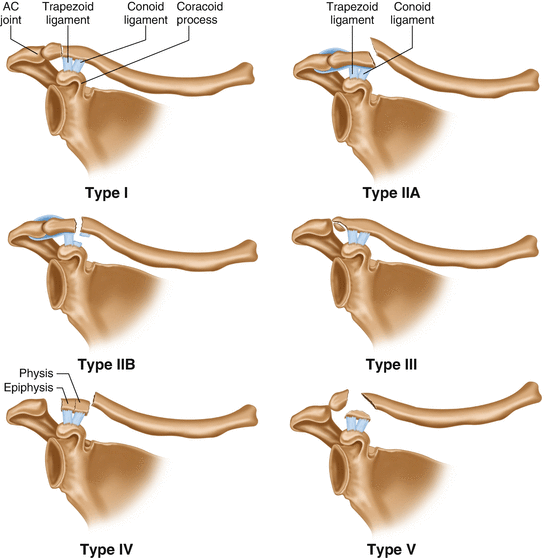 Distal Clavicle and Medial Clavicle Fractures | SpringerLink