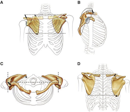 Complications of Clavicle Fractures | SpringerLink