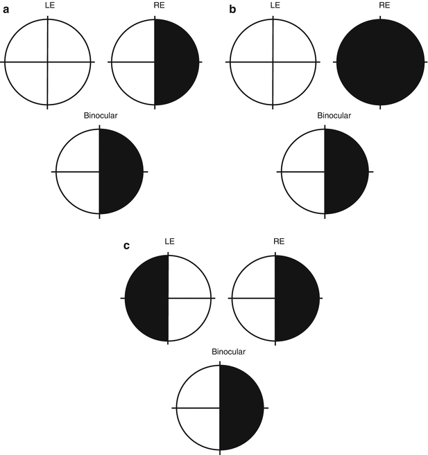 Neuro-Ophthalmological Examination in Homonymous Visual Field Defects ...