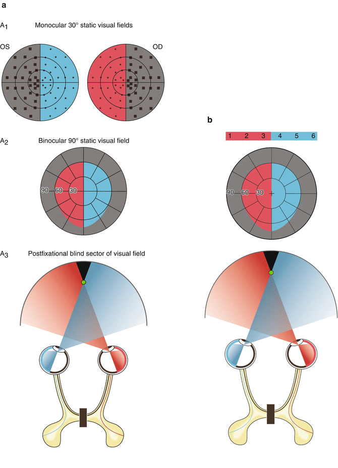 Neuro-Ophthalmological Examination in Homonymous Visual Field Defects ...