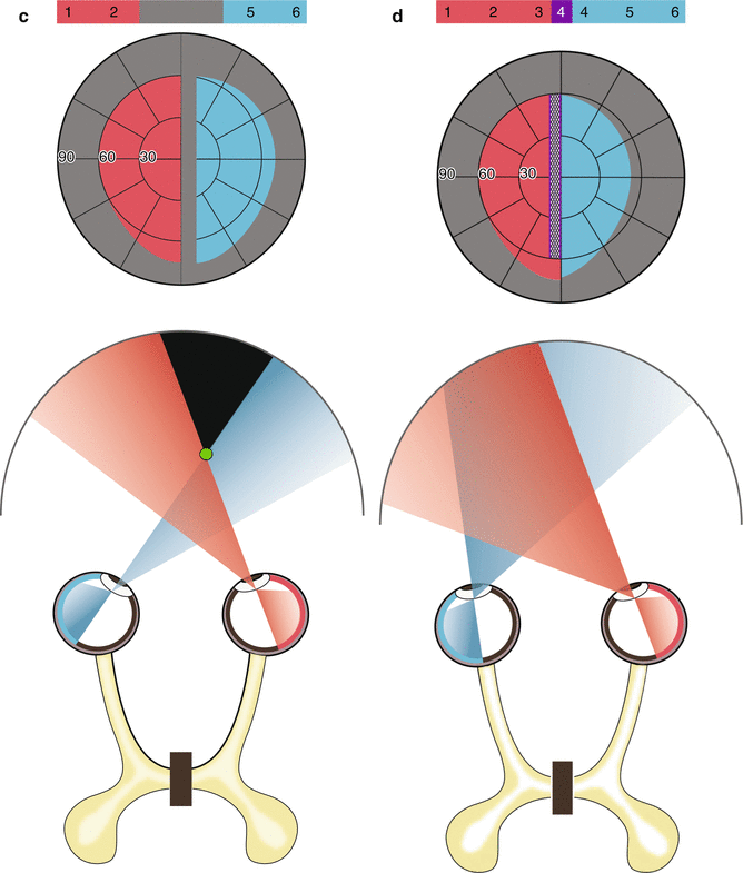 Neuro-Ophthalmological Examination in Homonymous Visual Field Defects ...
