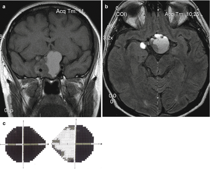 Types of Homonymous Visual Field Defects | SpringerLink
