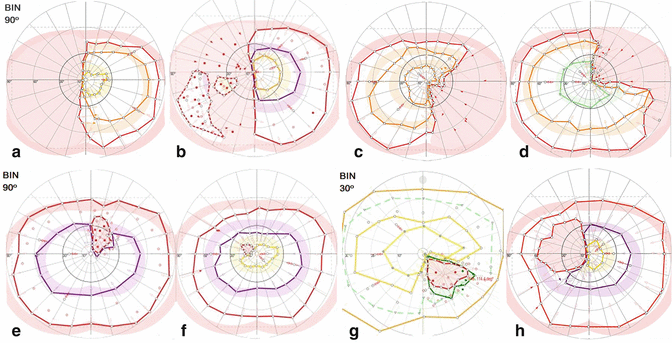 Types of Homonymous Visual Field Defects | SpringerLink