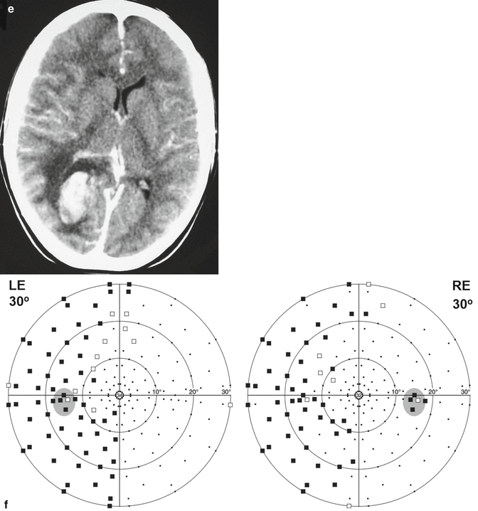Types of Homonymous Visual Field Defects | SpringerLink