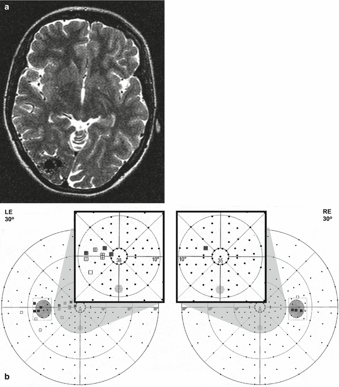Types of Homonymous Visual Field Defects | SpringerLink