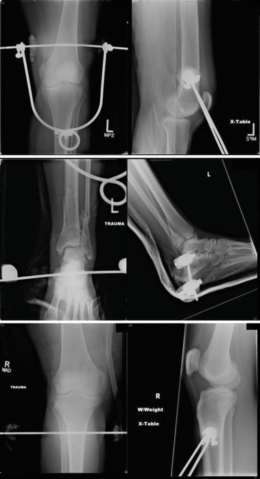 Traction Pin Placement | SpringerLink
